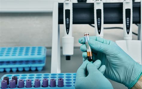 의료 실험실에서 환자의 혈액을 검사하는 동안 실험실 조수의 손에 시험관에있는 혈액 샘플 Dna에 대한 스톡 사진 및 기타 이미지 Dna Stem 주제 간호사 Istock