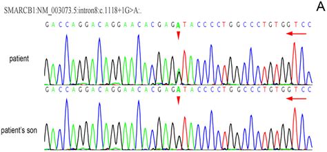 The Mutation Location C 11181ga On Intron 8 From The Genetic Tests
