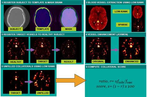 Computer Aided Diagnosis In Stroke AP Lab