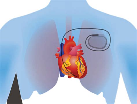 Pacemaker Implantation Doctor In Navi Mumbai Dr Rishi Bhargava