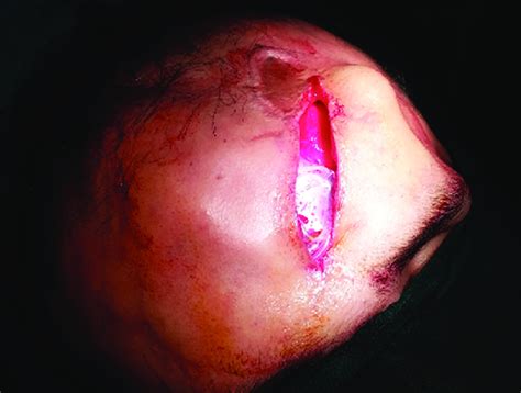 Tissue Expander In Situ Download Scientific Diagram