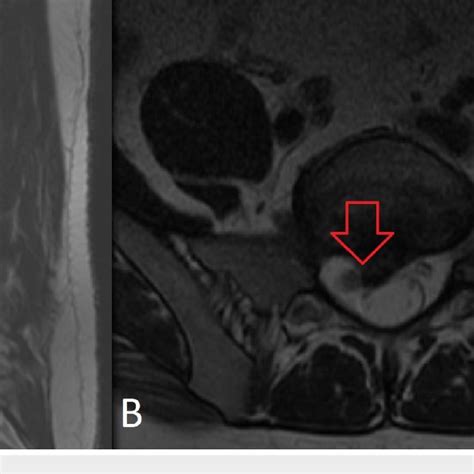 A T2 Sagittal Mri Of The Lumbar Spine Wo Contrast B Axial Mri Of The