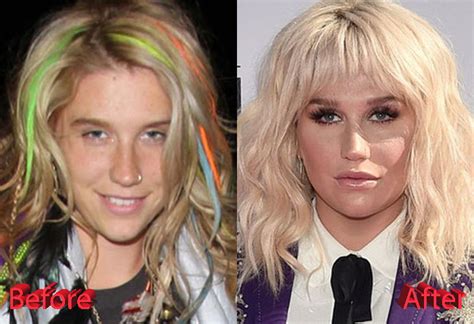Kesha Nose Job Before And After