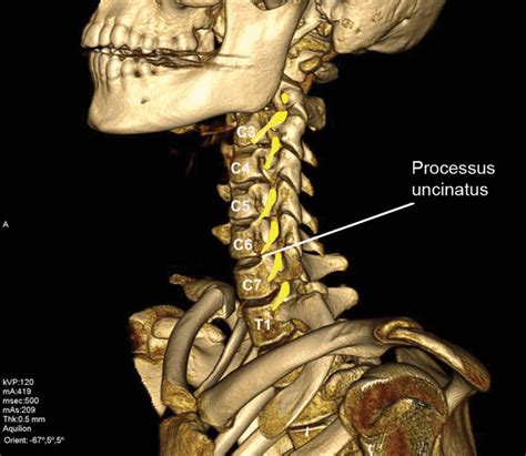 Complications Of Stellate Ganglion Block Sgb Anesthesia Key