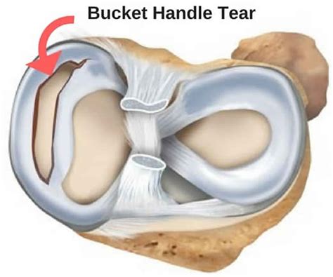 Meniscus Tear Knee Symptoms Signs Diagnosis Treatment And Recovery