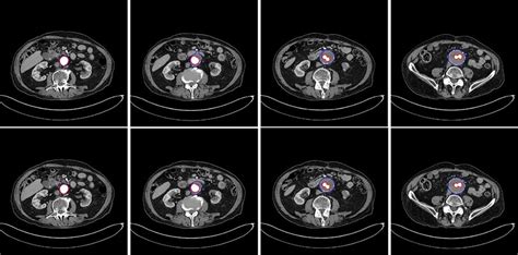 An Example Of Segmentation By The Two Pipelines With Axial