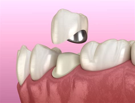 Dental Crown Types Nova DiŞ Beylikdüzü Ağız Ve Diş Sağlığı Merkezi