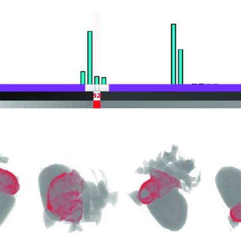 Rendering Of The Right Atrium Based On The Interactive Histogram A