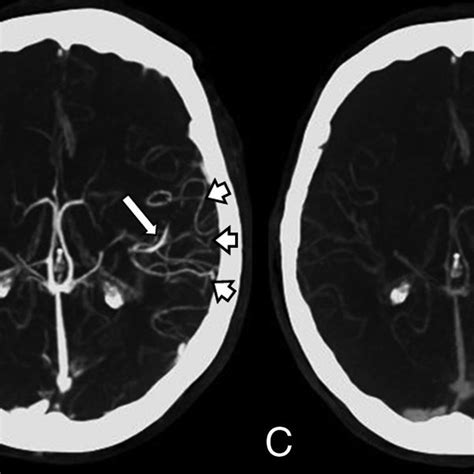 Multiphase Cta And Follow Up Mr Imaging Of An 83 Year Old Woman Download Scientific Diagram