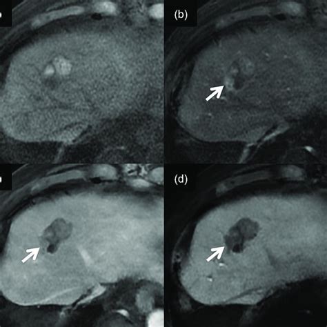 Recurrent Hepatocellular Carcinoma After Radiofrequency Ablation In An Download Scientific