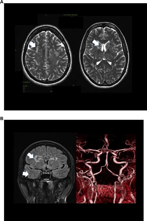 Cerebral Autosomal Dominant Arteriopathy Cadasil With Cardiac
