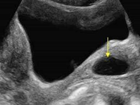 Gartners Cyst New