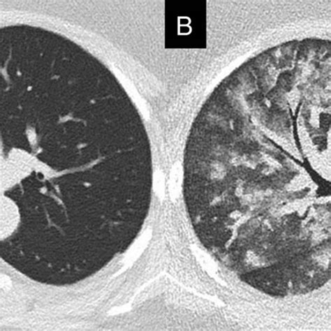 The Chest Computed Tomography Ct Findings A Low‐dose Computed
