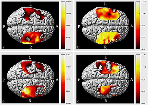 Low Frequency Rtms And Intensive Occupational Therapy Improve Upper