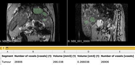 Analyse Multiple Tumour Segments As Individual Instances Support 3d