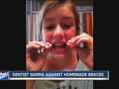 Diy Braces A Dangerous Trend