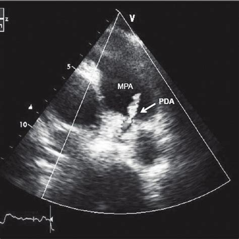 Colour Flow Doppler Across The Pda Demonstrating The Presence Of A Download Scientific Diagram