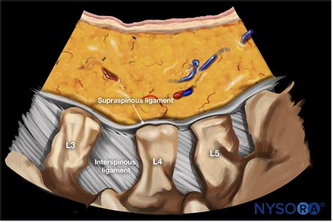 Ultrasound Guided Lumbar Nerve Root Periradicular 59 Off