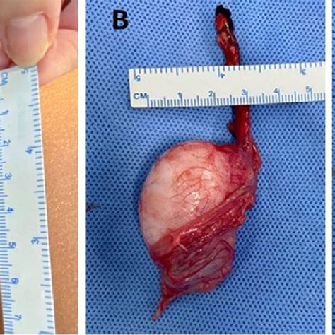 Treatment Algorithm Suggested By The Authors To Treat All Cases Download Scientific Diagram