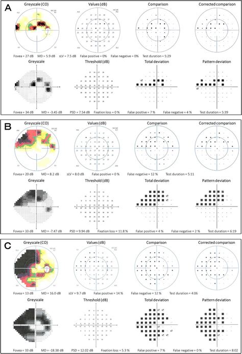 Representative Size Modulation Standard Automated Perimetry Sm Sap Download Scientific