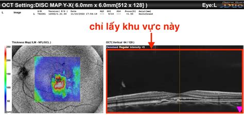 Ai Oct Analysis Tool 2024 Advanced Retinal Oct Diagnosis Hihorus Ai