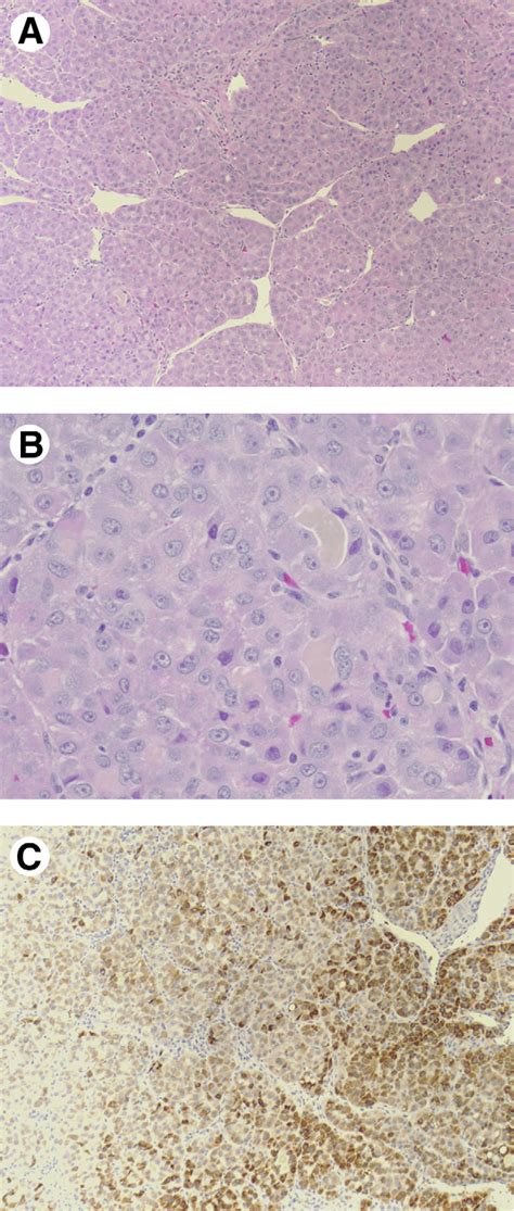 Figure 2 From A Rare Occurrence Of Hepatocellular Carcinoma Metastasis To The Mandible Report