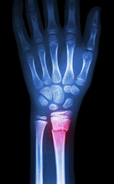 Can You Always See A Fracture In An X Ray University Of Utah Health