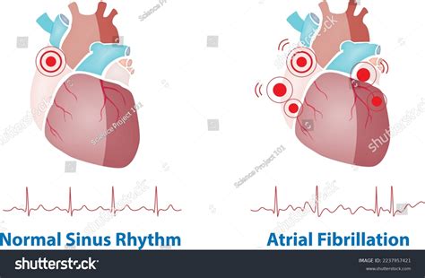 Normal Sinus Rhythm Vs Atrial Fibrillation Stock Vector Royalty Free
