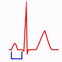 PR Interval