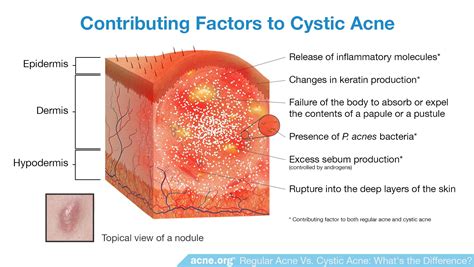 Regular Acne Vs Cystic Acne Whats The Difference