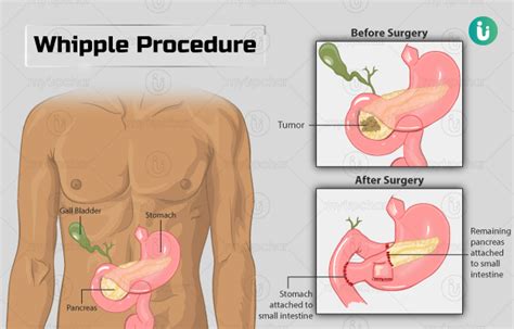 Whipple Procedure Procedure Purpose Results Cost Price