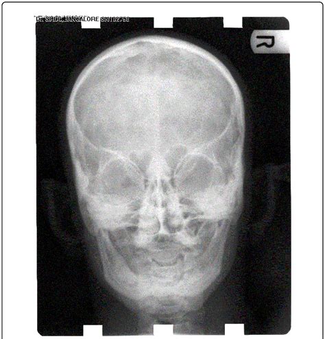 Postero Anterior View Of The Skull True Lateral Cephalogram Of Patient Download Scientific