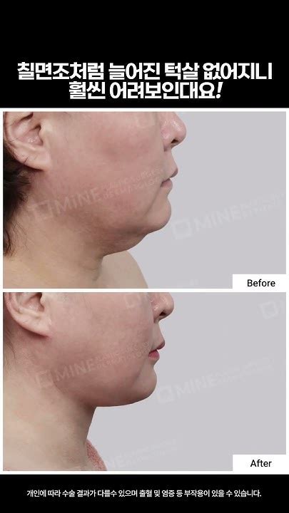 늘어진 턱살 없애고 예쁜 동안 얼굴 얻었어요😍 이중턱근육묶기 미니목거상 미니목 이중턱 턱살 턱선 이중턱지방흡입