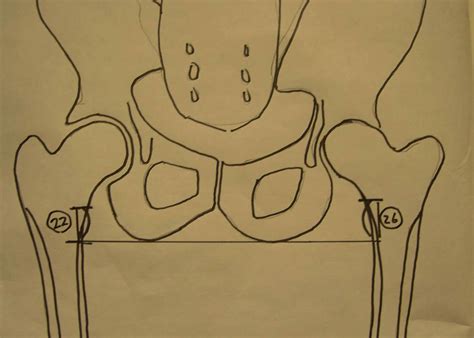 Tha Templating Recon Orthobullets