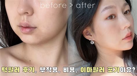 턱끝필러 일주일 변화 후기 이마필러 포기한 이유 부작용 비용 💉 Youtube
