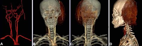 Computed Tomography Angiography Cta Three Dimensional Reconstruction