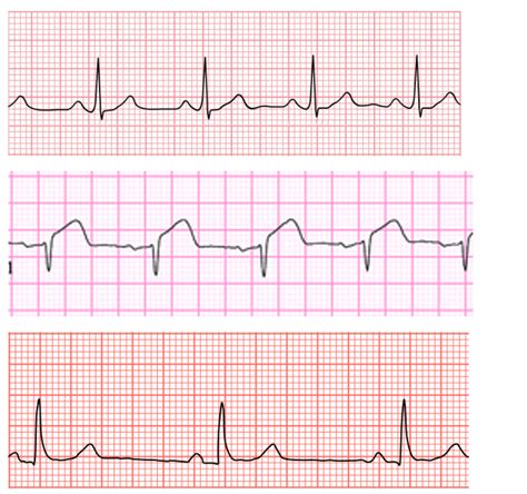 3 ﻿on A Diagram Of An Ecg Label The P Wave Qrs