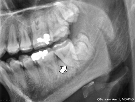 Roentgen Ray Reader Radiographic Features Of Hyperparathyroidism