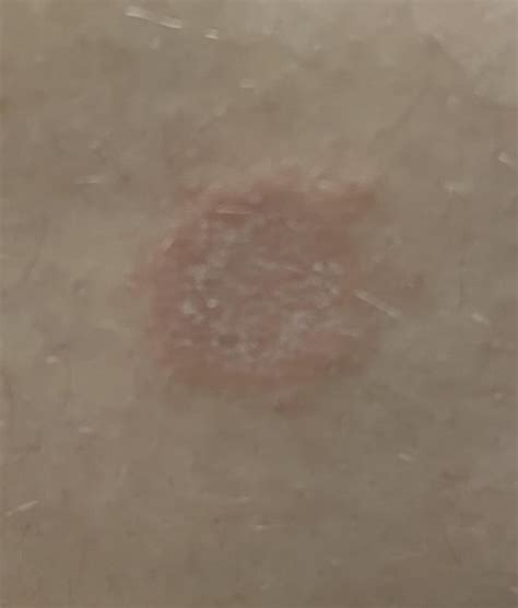 Ringworm T T Doesnt Look Gross Just Spoiler Ing In Case R