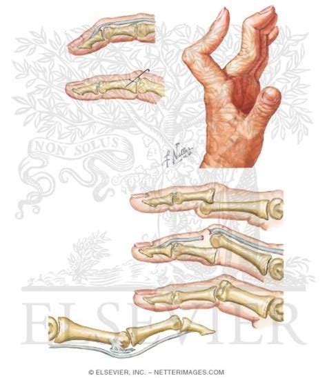 Proximal Interphalangeal Joint Dislocations