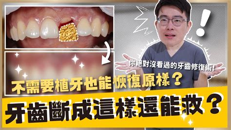 牙齒斷到牙根還有救嗎？牙齒斷裂一定要拔牙？從牙齒斷裂、治療方式完整解說！3種牙裂案例帶你一次看！｜【祐民牙醫－隱適美旗艦店】鑽石級楊大為醫師