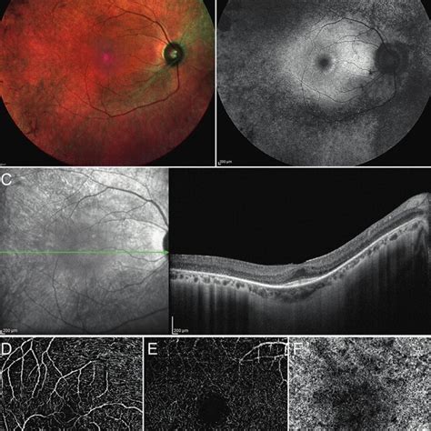 Multimodal Retinal Imaging In Prph2 Gene Related Pattern Dystrophy Download Scientific Diagram