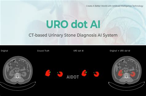 Бөөр шээсний замын чулуу илрүүлэх хиймэл оюун ухааны шийдэл “urodot Ai” Aidot Mongolia