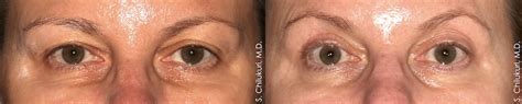 Blepharoplasty 1 Refresh Dermatology