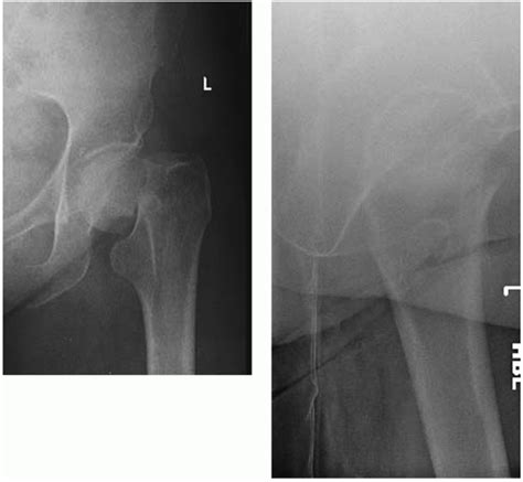 Tibial Pilon Fractures Open Reduction Internal Fixation Teachme Orthopedics