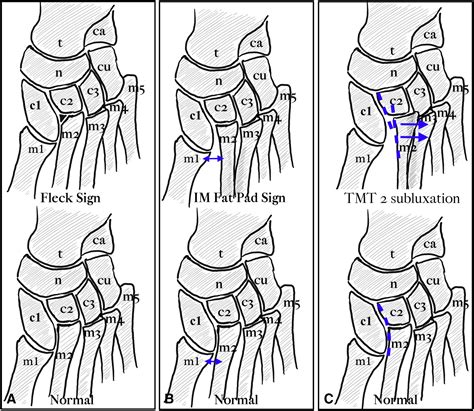 Not To Be Missed Subtle Radiographic Findings Of The Ligamentous