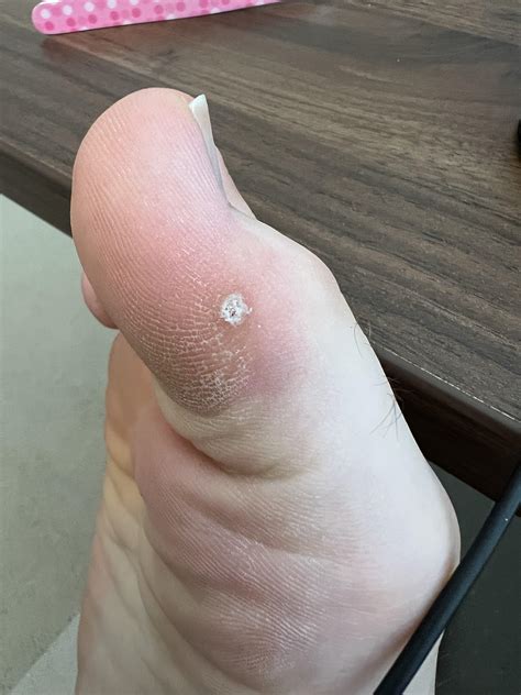 Is This A Wart On My Big Toe Going To See A Derm Soon Rwarts