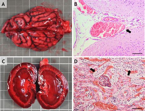A Diffuse Subendocardial Hemorrhages B Myocardial Congestion And