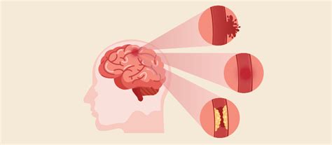 Hemorrhagic Vs Ischemic Stroke Whats The Difference