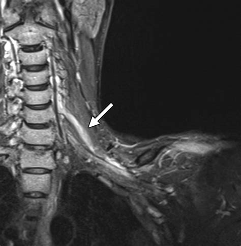 Radiation Induced Brachial Plexopathy Success Story 54 Off